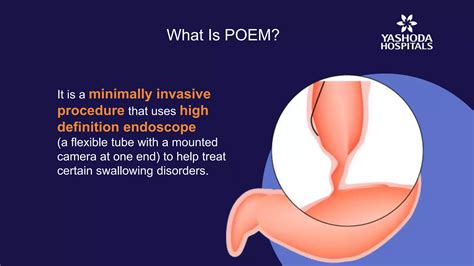 Peroral Endoscopic Myotomy Poem Treatment For Achalasia Of