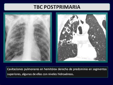 Manifestaciones Radiológicas De La Tuberculosis Pulmonar Semantic Scholar