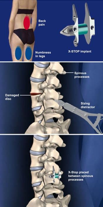 Interspinous Process Decompression — X Stop® The Southeastern Spine