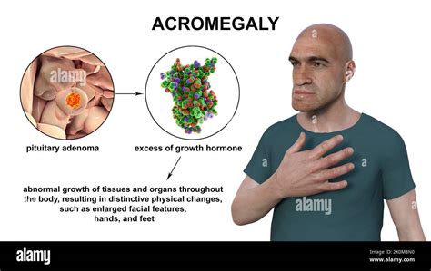 3d Illustration Of A Man With Acromegaly This Is A Condition Causing