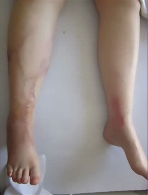 Pseudocellulitis Need Not Be Benign Three Cases Of Superficial Migratory Thrombophlebitis With