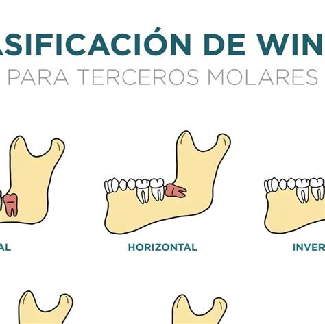 Deposito Dental Roentgen On Instagram 🦷 ¿conoces La Clasificación De