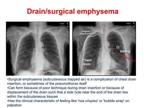 Pneumothorax In Chest Xray Interpretationpptx Pptx
