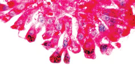 Soft Tissue Sarcoma Types Causes Symptoms Diagnosis And Treatment Doctor Vin