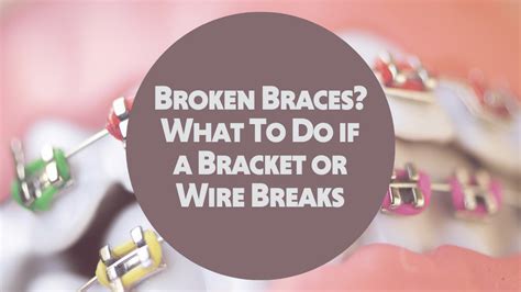 What To Do If A Braces Band Breaks At Will Mcguirk Blog