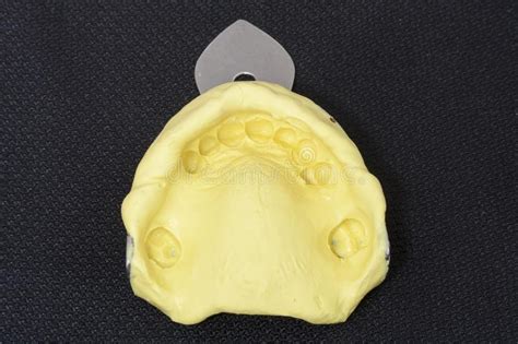 Oral Rehabilitation Process Partial Removable Prosthesis Stock Image Image Of Dentures Oral Rehabilitation Process Partial Removable Prosthesis Stock Image Image Of Dentures