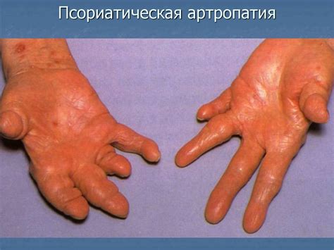 Псориаз, КПЛ - презентация онлайн