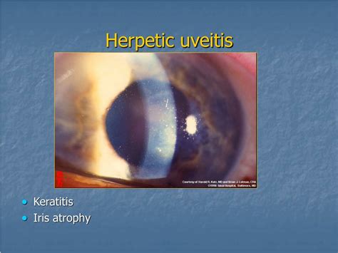 Ppt Uveal Diseases Powerpoint Presentation Free Download Id1071275