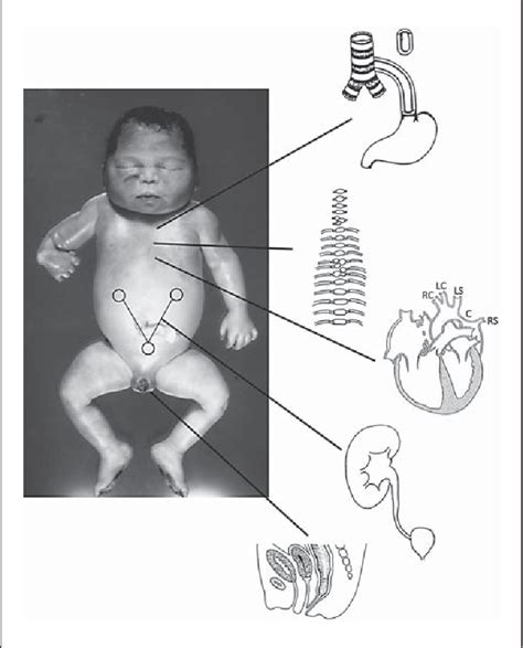 Figure 2 From Considering The Embryopathogenesis Of Vacterl Association