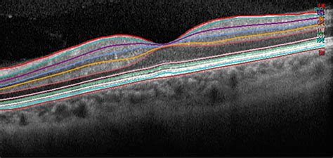 Segmentation Of The Retinal Layers Single Horizontal Foveal Scans Were