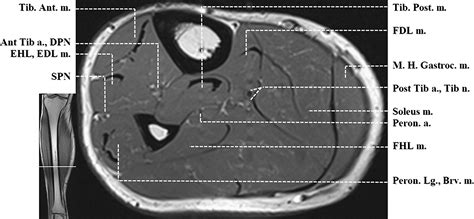 Supplemental Materials For Normal Mr Imaging Anatomy Of The Thigh And