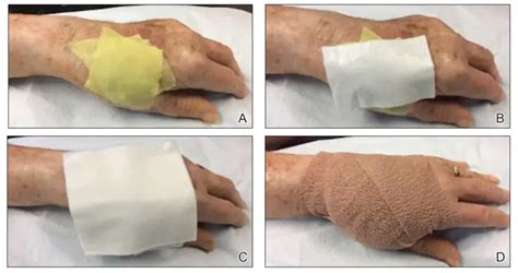 Understanding Lymphedema Wound Dressings Options And Benefits Shunvogue