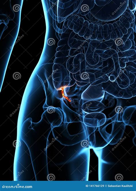 An Inflamed Appendix Stock Illustration Illustration Of Injury 141766129