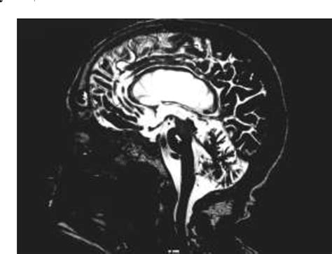 Figure 1 From Diagnostic Value Of Mri Csf Flowmetry For The Diagnosis