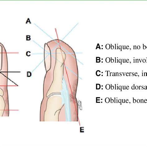 Tang Et Al Digital Tip Injury Classification The Digital Zone Tang Et Al Digital Tip Injury Classification The Digital Zone
