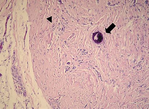 Figure 3 From Multiple Calcifying Fibrous Tumors In The Small Intestine And The Mesentery