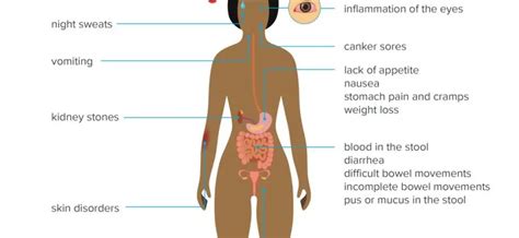 Inflammatory Bowel Disease Causes Symptoms Treatment Healthy Food