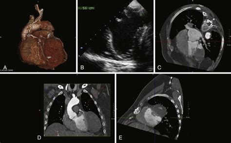 Assessment Of Left Ventricular Structural Abnormalities Radiology Key