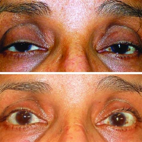 Pdf Closed Posterior Levator Advancement In Severe Ptosis