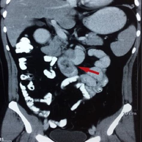 How Rare Is Brunners Gland Hyperplasia At Ruby Vannatter Blog
