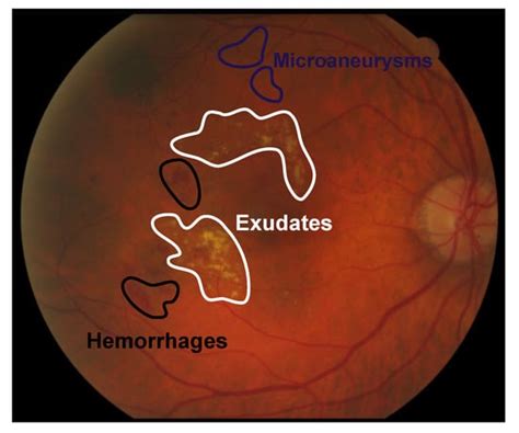 Detection Of Early Signs Of Diabetic Retinopathy Based On Textural And