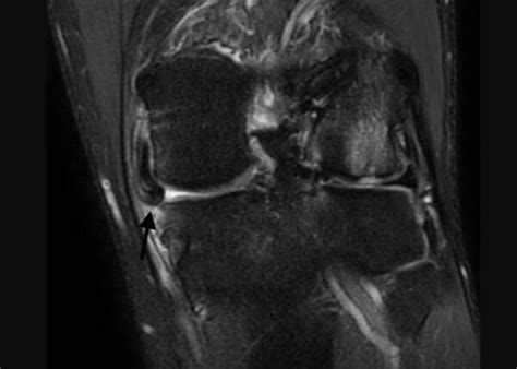 Lateral Meniscus Tear Posterior Horn Lesions Of The Menisci