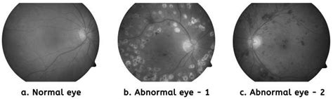 Sample Grayscaled Fundus Images Normal A And Abnormal B And C