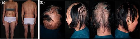 Ixekizumab Improved Refractory Erythrodermic Psoriasis With Comorbid D