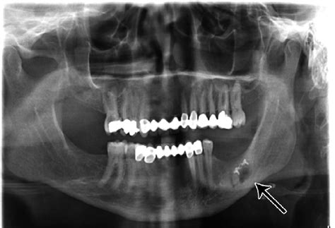 Preoperative Coronal View Of The Remaining Root Of The Tooth Extracted