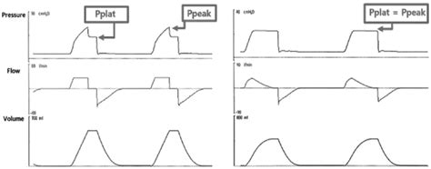 Basic Waveforms Of Volume Control And Pressure Control Mode Pplat