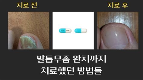 발톱무좀 완치까지 치료했던 방법들 Youtube