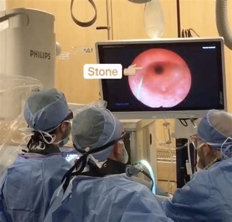 Non Surgical Gallstone Removal Cholangioscopy Technique