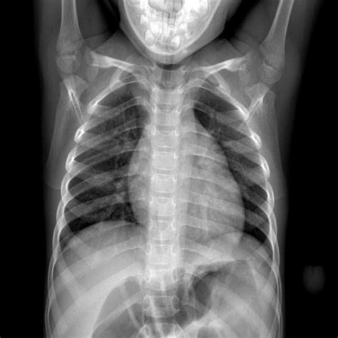 Hongrui Xray V 1 · Datasets At Hugging Face