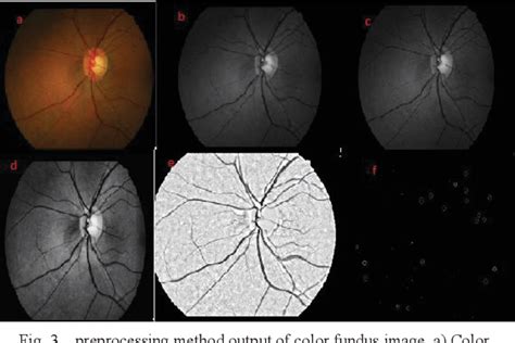 Figure 3 From Automatic Detection And Classification Of Microaneurysms For Early Detection Of