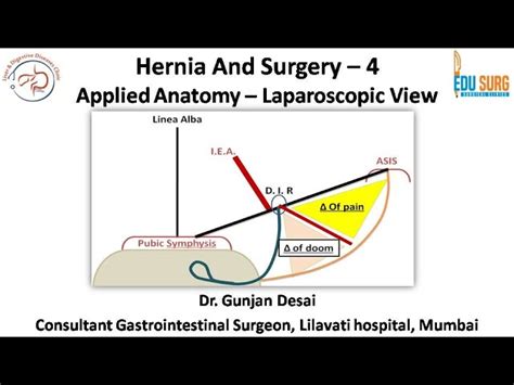 Laparoscopic Inguinal Hernia Anatomy Laparoscopic Inguinal Hernia Anatomy