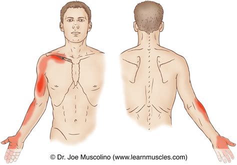Scalenes Trigger Points