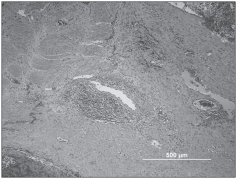 Subcutaneous Hemangiosarcoma Induced By A Foreign Body Steel Staple