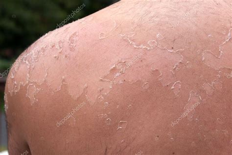 Bad Sunburn Peeling Skin