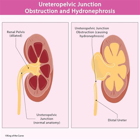 🚑 Ureteropelvic Junction Obstruction And Hydronephrosis — King Of The Curve