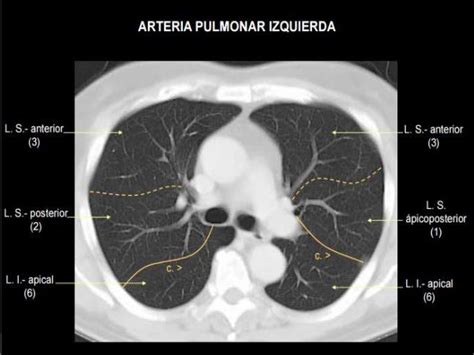Segmentacion Pulmonar Tac