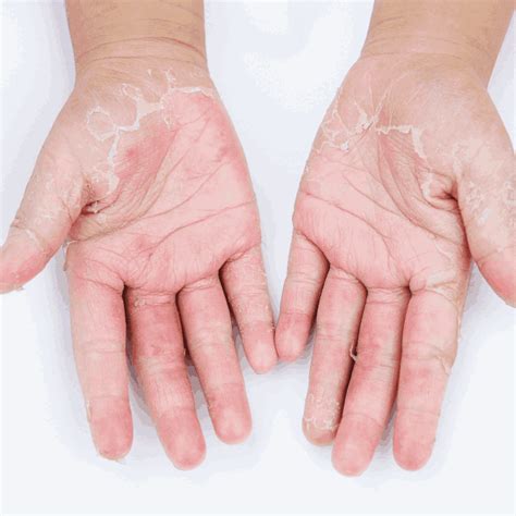 Understanding Fungal Infections Causes Symptoms And Treatments