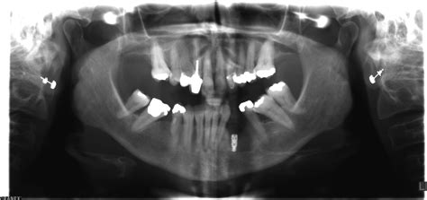 Floor Of Mouth Hematoma Following Dental Implant Placement Literature Review And Case