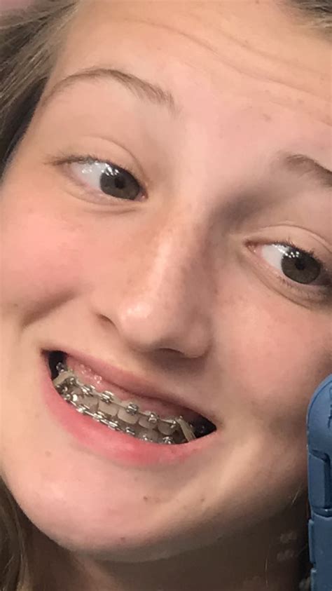 Pin By CD On Braces Dental Braces Braces Rubber Bands Orthodontic Appliances