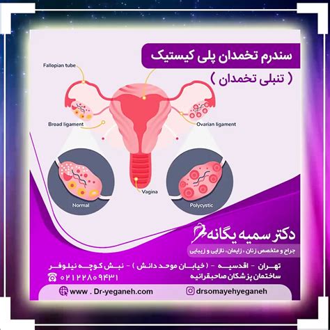 سندرم تخمدان پلی کیستیک یا تنبلی تخمدان