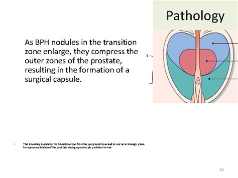 Benign Prostatic Hyperplasia Bph Dr Ammar Fadil Bph
