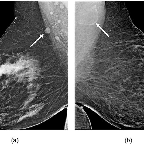 Variable Axillary Lymph Node Size And Morphology On Breast Mri 65 Y O Download Scientific