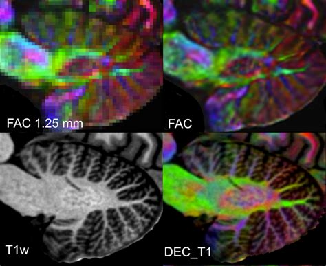 Sagittal Plane Showing The Cerebellar Dentate Nucleus Across A