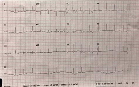 Showing Ecg After Right Sided Placement Of Precordial Leads And