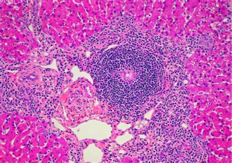 Path Liver Lec 6and7 Hepatitis Cholangitis Cholangiohepatitis Flashcards Quizlet