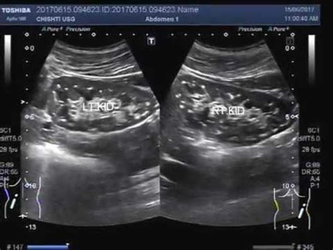 Ultrasound Video Showing Bilateral Renal Microlithiasis Youtube